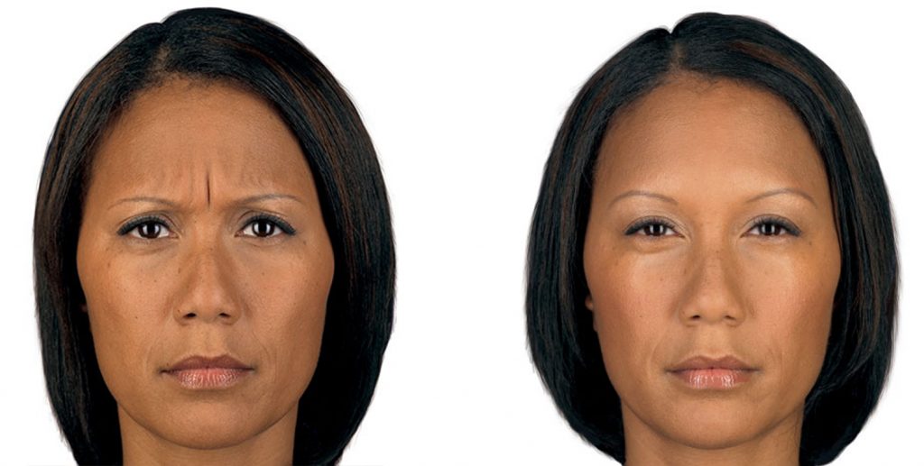 Botox Treatments Boise | Rodgers Center for Plastic Surgery