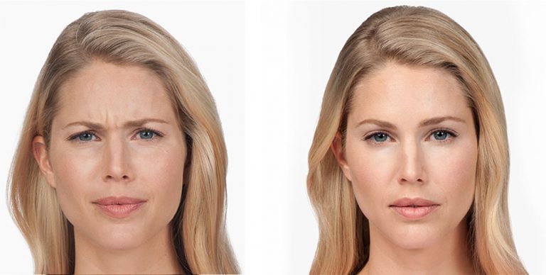 Botox Treatments Boise | Rodgers Center for Plastic Surgery